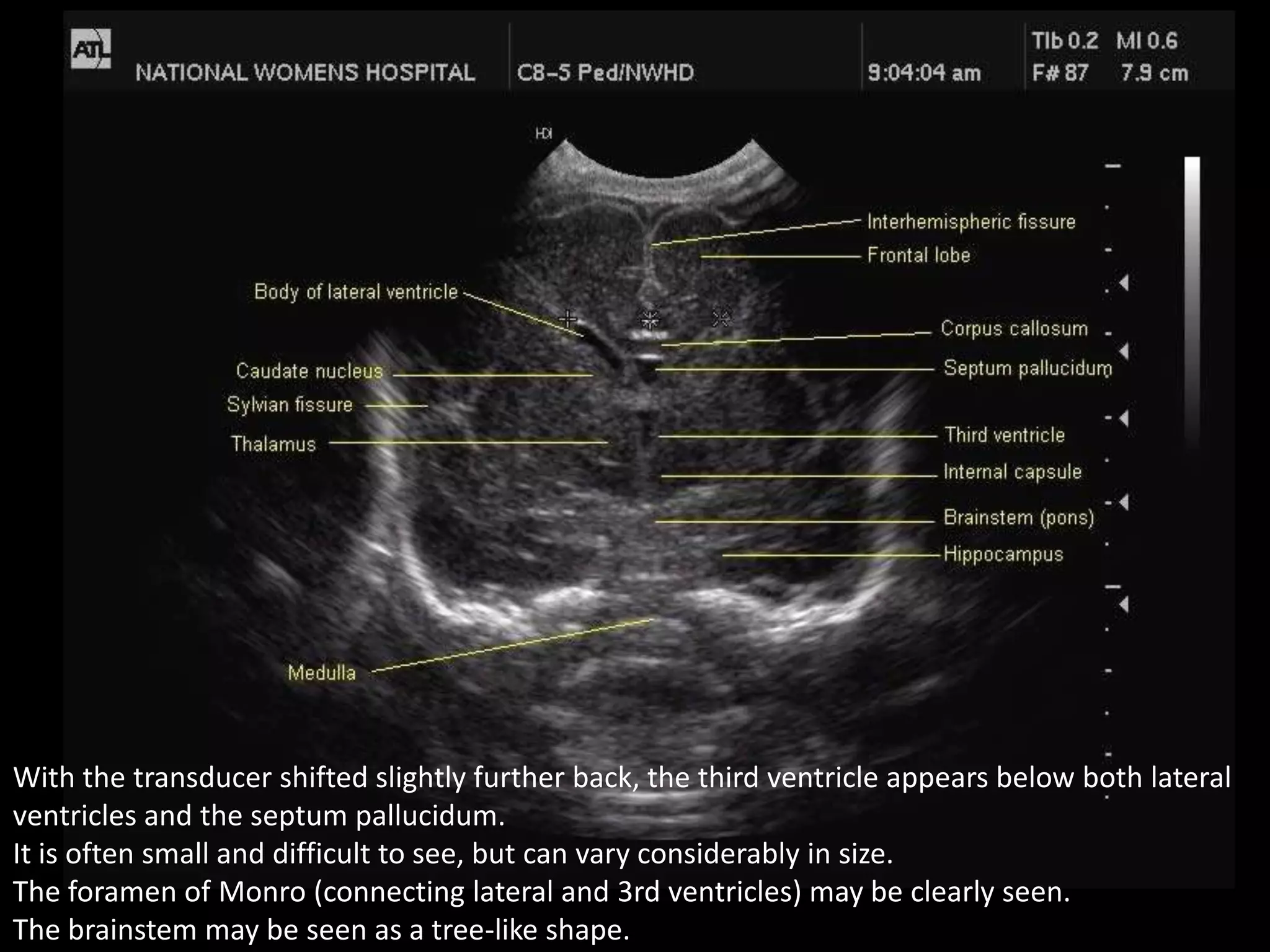 Neurosonogram.. Dr.Padmesh | PPTX