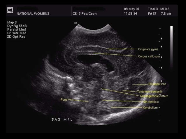 Neurosonogram.. Dr.Padmesh | PPTX