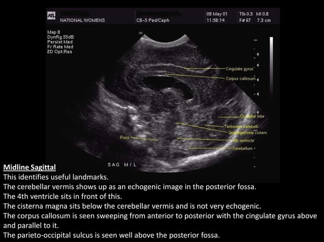 Neurosonogram.. Dr.Padmesh | PPTX