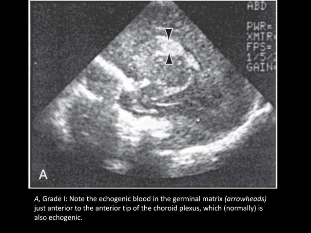 Neurosonogram.. Dr.Padmesh | PPTX