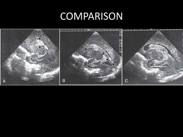 Neurosonogram.. Dr.Padmesh | PPTX