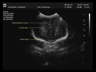 Neurosonogram.. Dr.Padmesh | PPTX