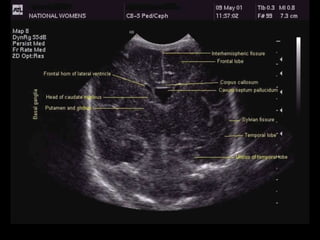 Neurosonogram.. Dr.Padmesh | PPTX