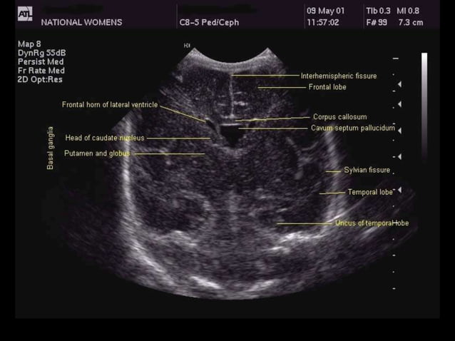 Neurosonogram.. Dr.Padmesh | PPTX