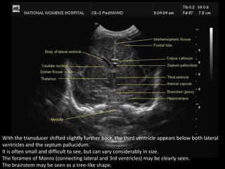 Neurosonogram.. Dr.Padmesh | PPTX