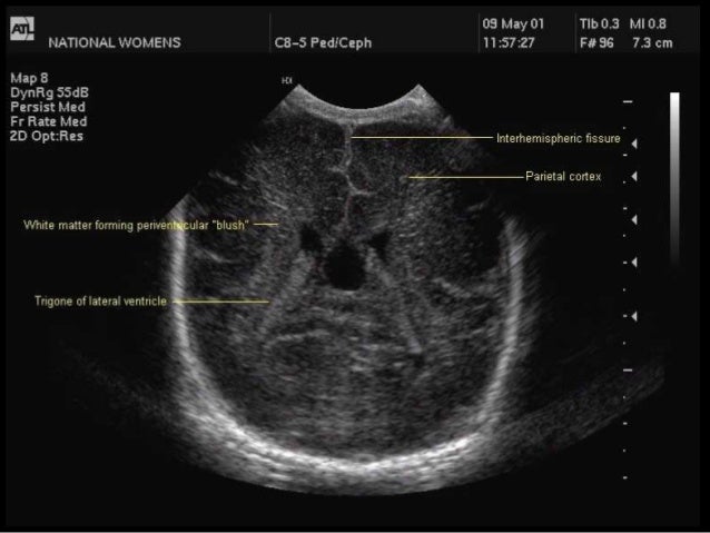Neurosonogram.. Dr.Padmesh