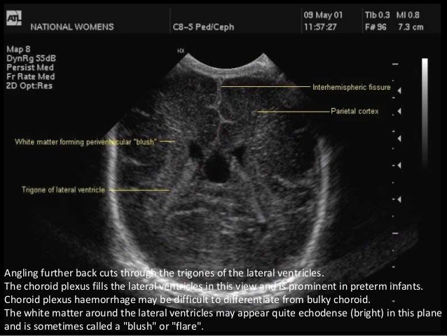 Neurosonogram.. Dr.Padmesh