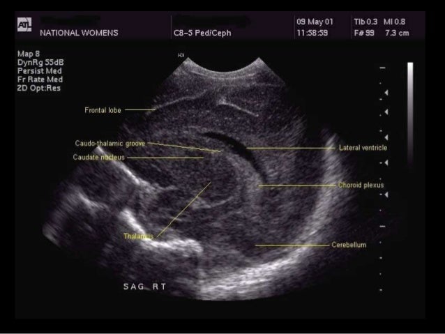 Neurosonogram.. Dr.Padmesh