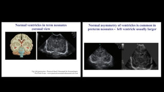 STANDARD PLANES IN NEUROSONOGRAM AND HOW TO AQUIRE THEM | PPTX