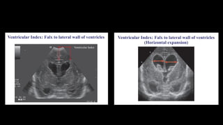 STANDARD PLANES IN NEUROSONOGRAM AND HOW TO AQUIRE THEM | PPTX