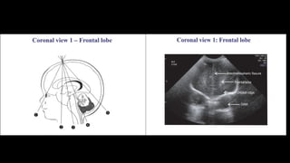 STANDARD PLANES IN NEUROSONOGRAM AND HOW TO AQUIRE THEM | PPTX