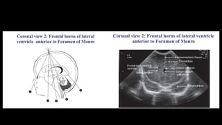 STANDARD PLANES IN NEUROSONOGRAM AND HOW TO AQUIRE THEM | PPTX