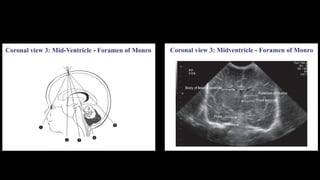 STANDARD PLANES IN NEUROSONOGRAM AND HOW TO AQUIRE THEM | PPTX