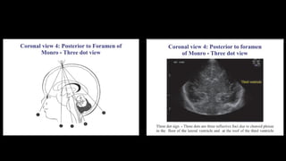 STANDARD PLANES IN NEUROSONOGRAM AND HOW TO AQUIRE THEM | PPTX