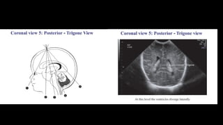 STANDARD PLANES IN NEUROSONOGRAM AND HOW TO AQUIRE THEM | PPTX