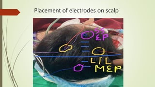 Neuro spinal monitoring | PPT