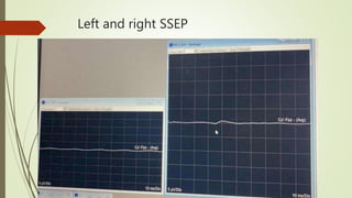 Neuro spinal monitoring | PPT
