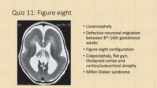 Neurospot | PPTX | Blood Disorders | Diseases and Conditions