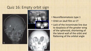 Neurospot | PPTX | Blood Disorders | Diseases and Conditions