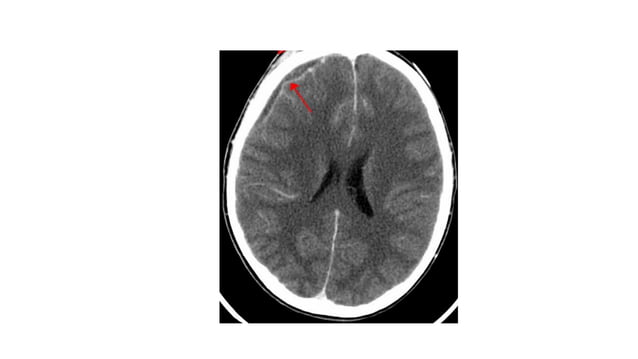 Brain tumors classification management.pptx