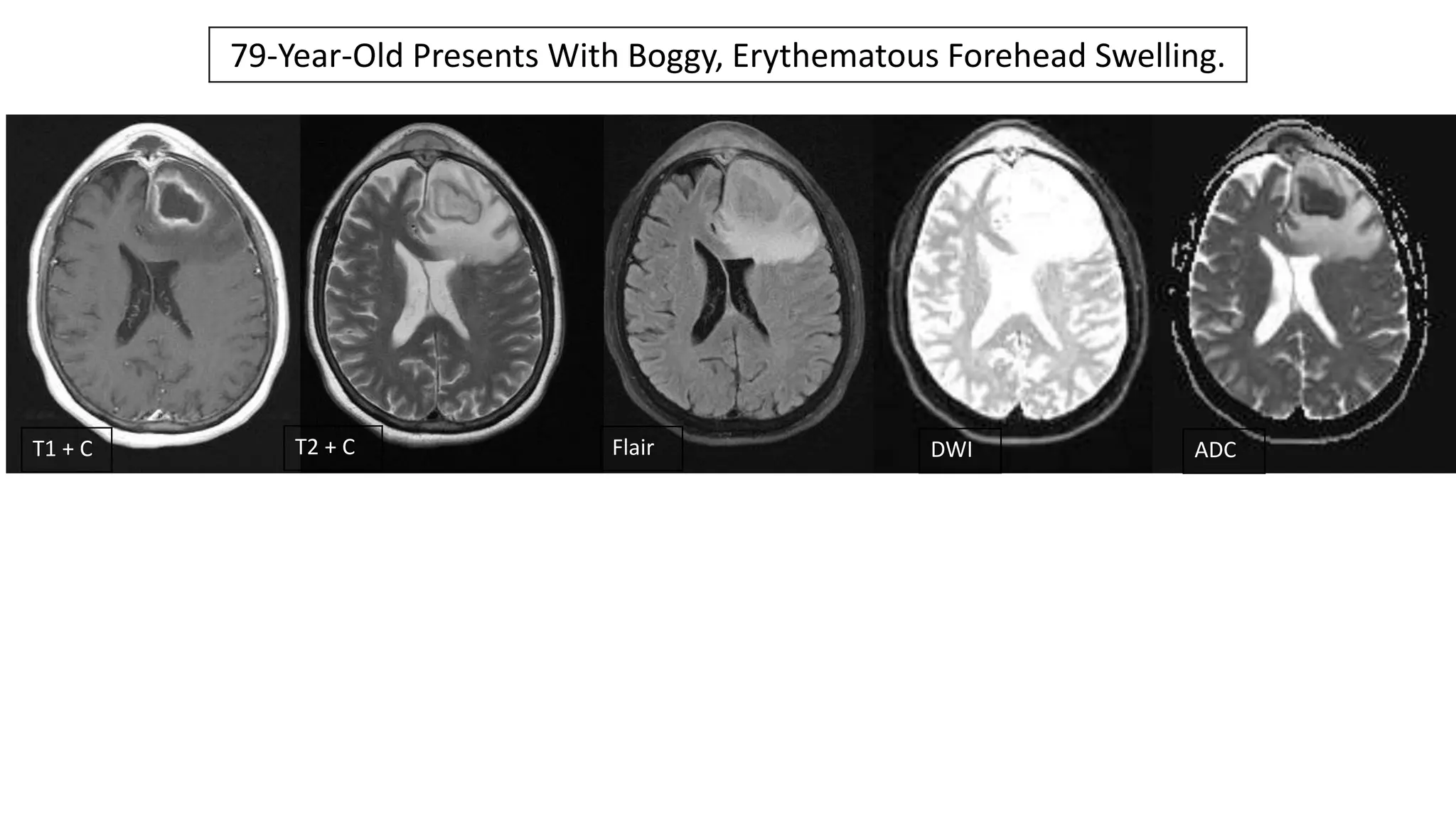 Neurosurgical Intracranial Infections - FINAL 10-17-23.pptx