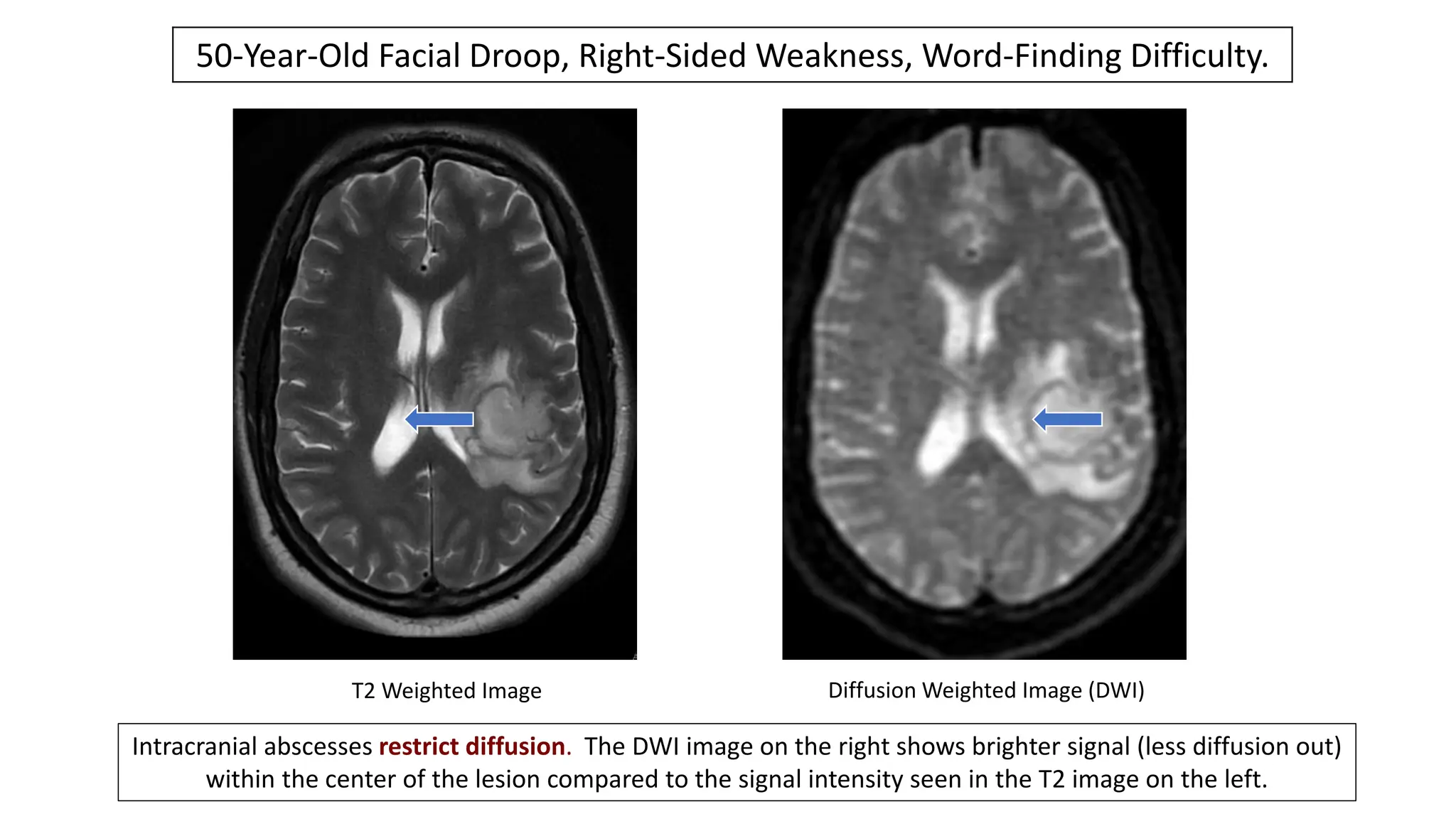 Neurosurgical Intracranial Infections - FINAL 10-17-23.pptx