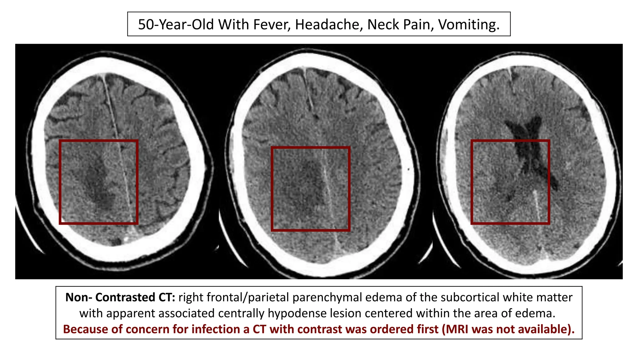 Neurosurgical Intracranial Infections - FINAL 10-17-23.pptx