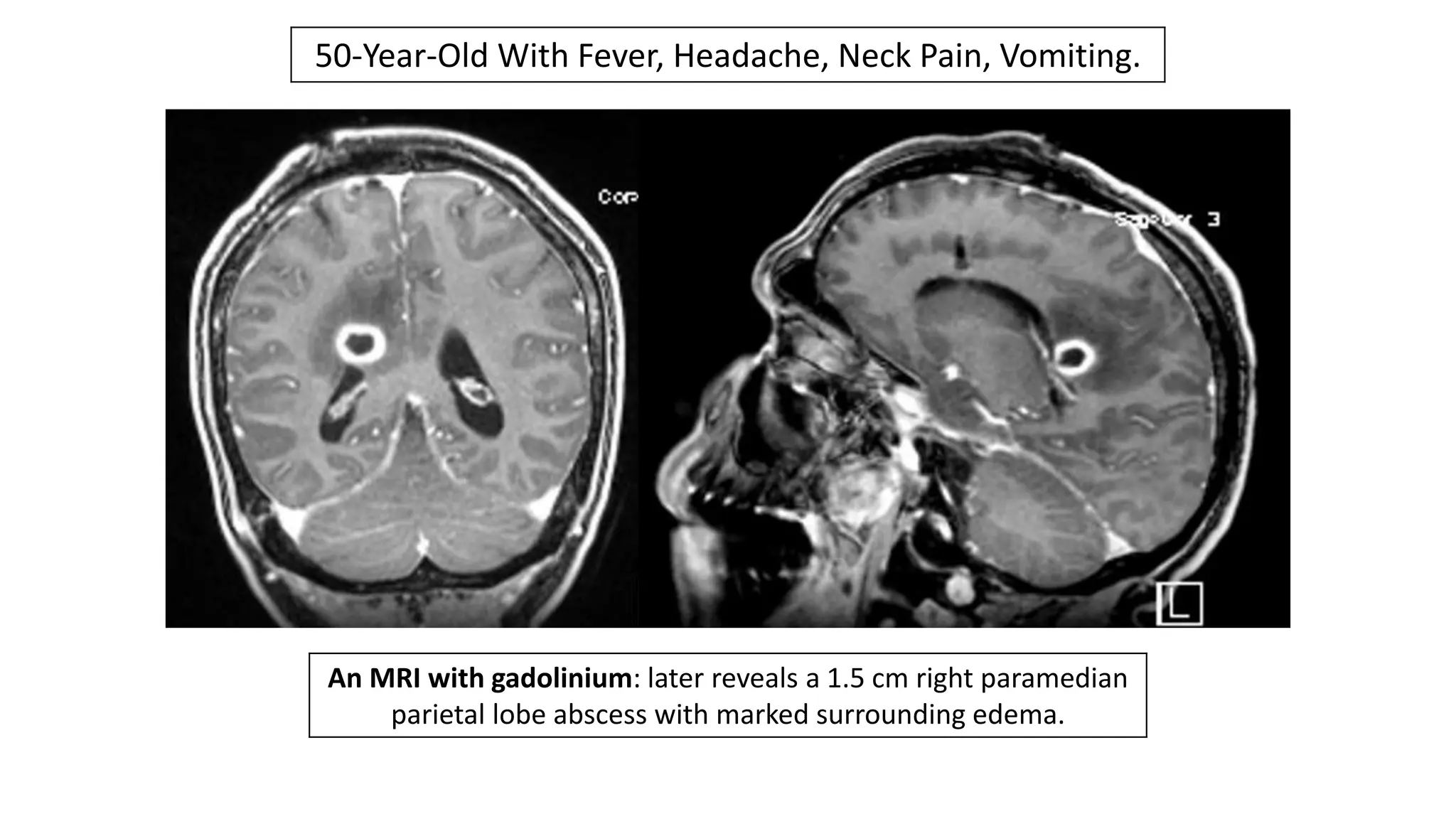 Neurosurgical Intracranial Infections - FINAL 10-17-23.pptx