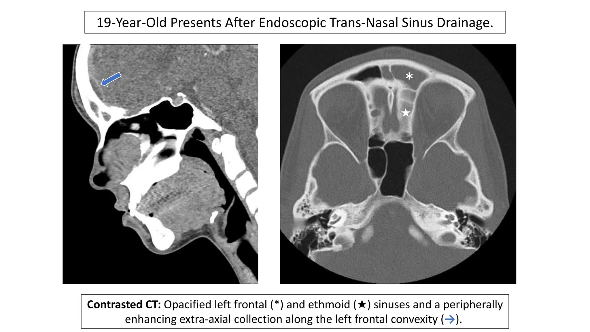 Neurosurgical Intracranial Infections - FINAL 10-17-23.pptx