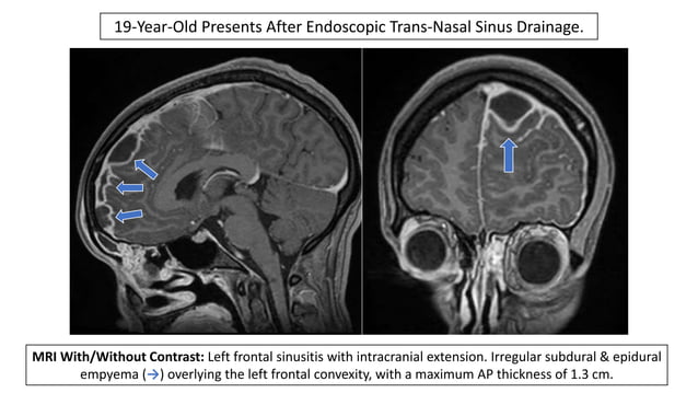 Neurosurgical Intracranial Infections - FINAL 10-17-23.pptx