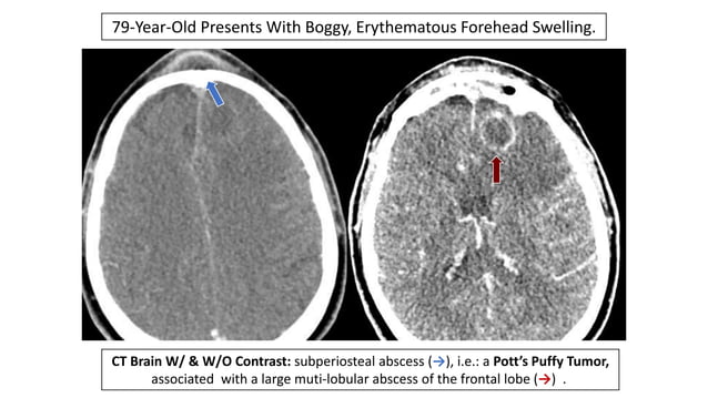 Neurosurgical Intracranial Infections - FINAL 10-17-23.pptx