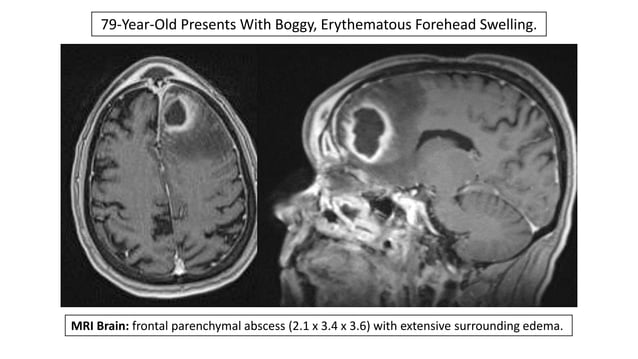 Neurosurgical Intracranial Infections - FINAL 10-17-23.pptx