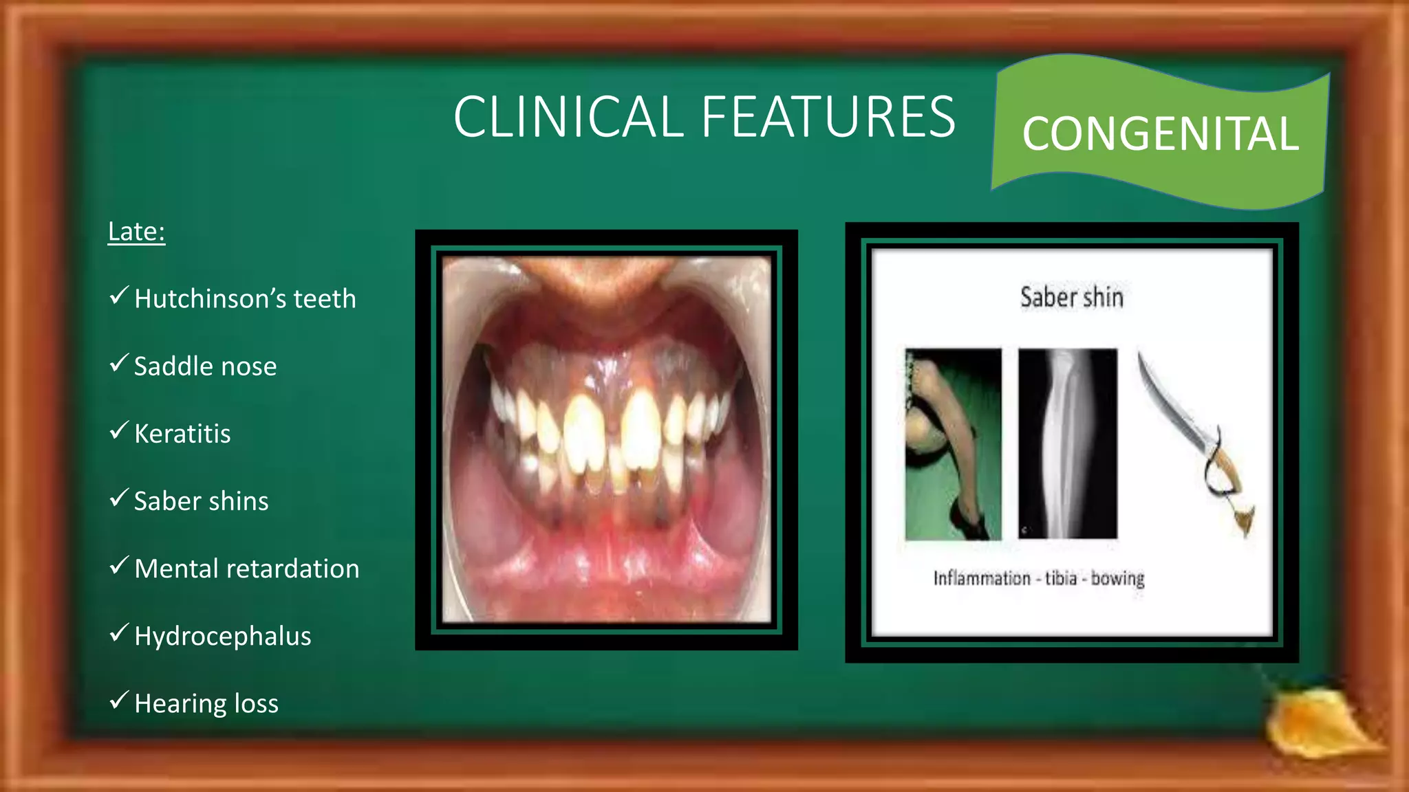 Neuro syphilis | PPTX