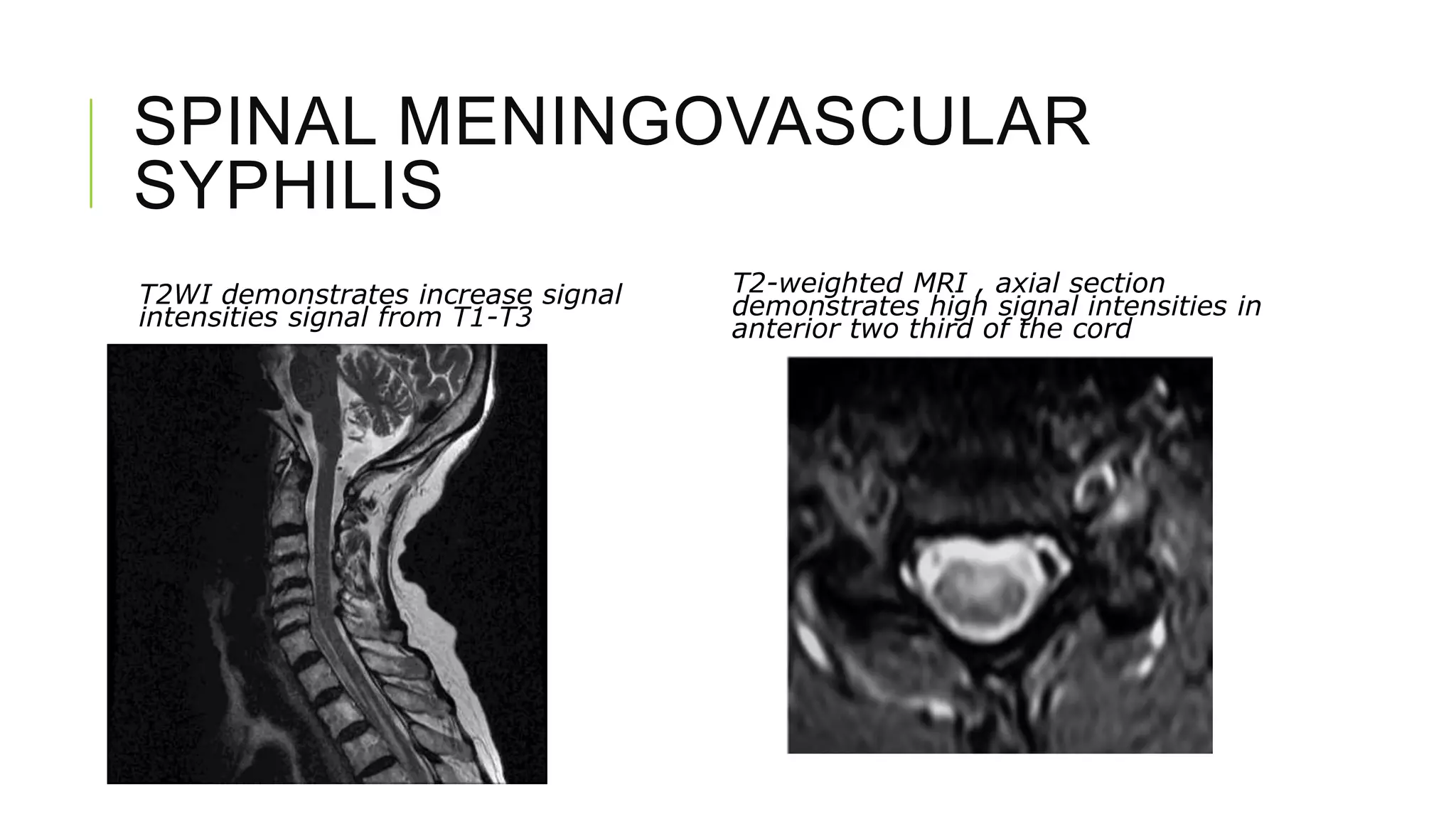 Neurosyphilis | PPTX