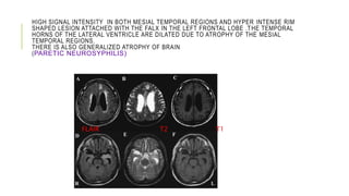 Neurosyphilis | PPTX