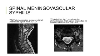 Neurosyphilis | PPTX
