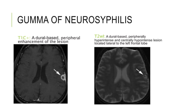 Neurosyphilis | PPTX