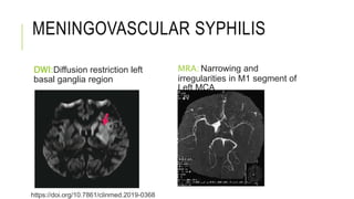 Neurosyphilis | PPTX