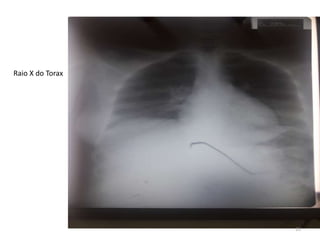 Neuro Toxoplasmose | PPTX