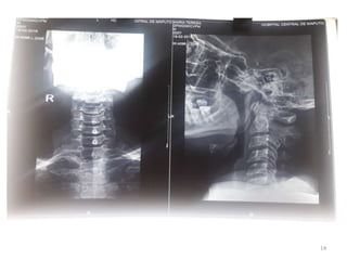 Neuro Toxoplasmose | PPTX