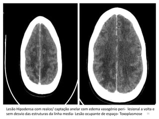 Neuro Toxoplasmose | PPTX