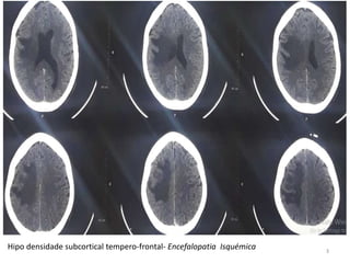 Neuro Toxoplasmose | PPTX