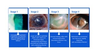 NEUROTROPHIC KERATOPATHY and EXPOSURE KERATOPATHY 2.pptx