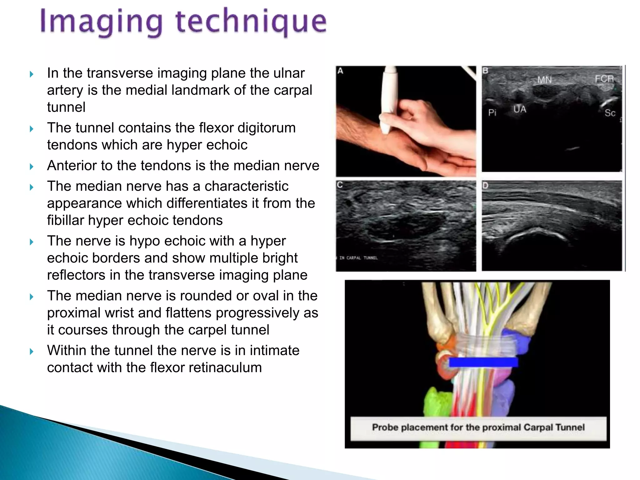 Neuro ultrasound in carpal tunnel syndrome | PPTX