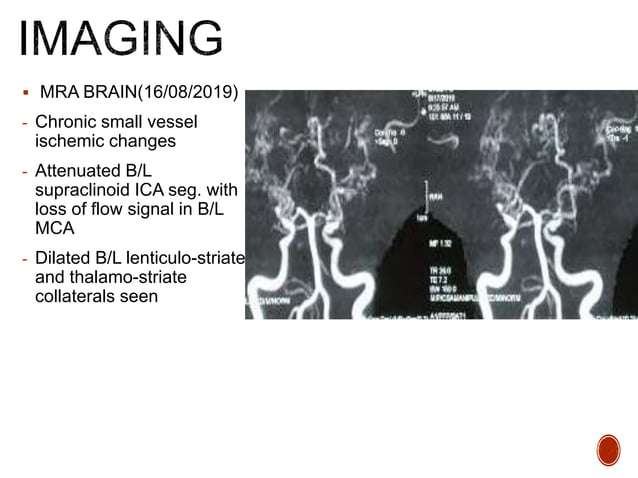 Neurovascon 2019 Moya- Moya Disease case 3 | PPT