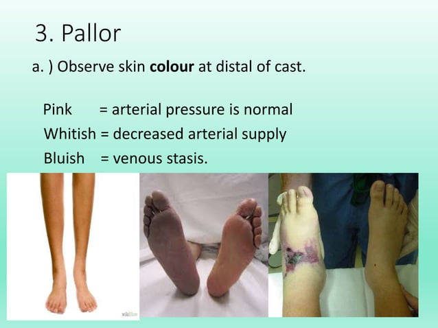 Neurovascular assessment | PPTX | First Aid | Injuries