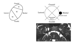 Neurovascular compression syndromes.pptx
