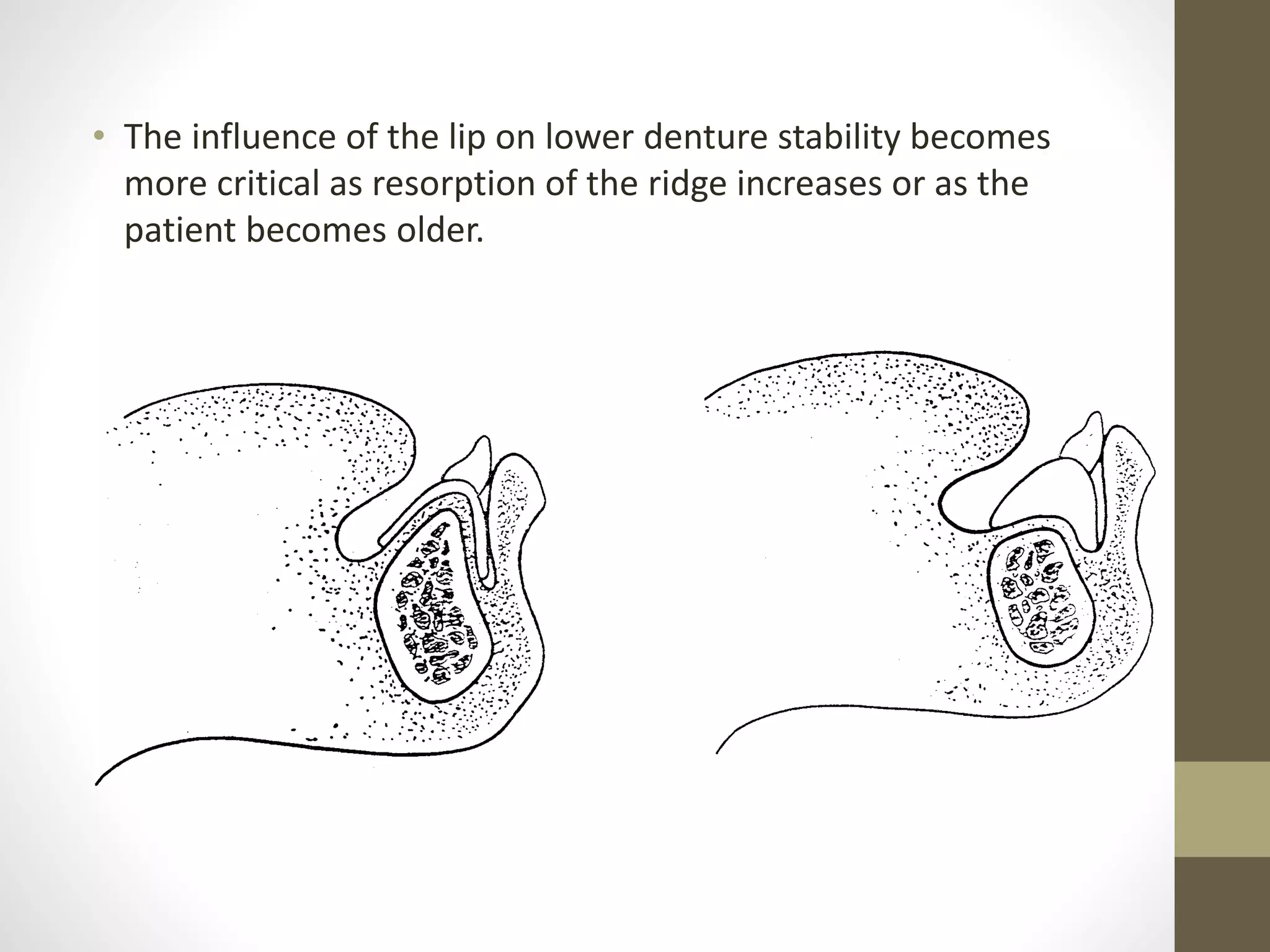 Neutral zone in complete dentures | PPTX