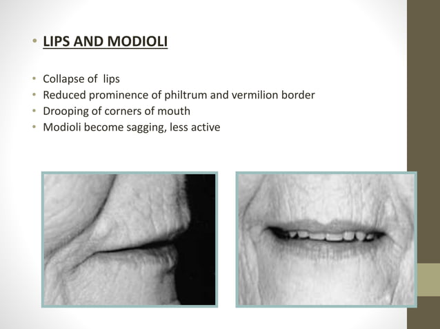 Neutral zone in complete dentures | PPTX | Dental Health | Diseases and ...