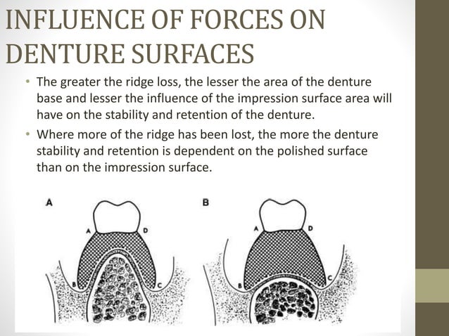 Neutral zone in complete dentures | PPTX | Dental Health | Diseases and ...